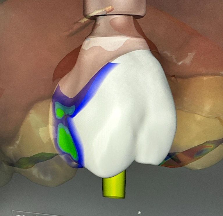 Scan to Screw: Digital Solutions to Place and Restore Dental Implants ...