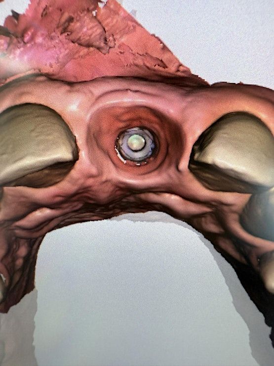 Scan to Screw: Digital Solutions to Place and Restore Dental Implants ...